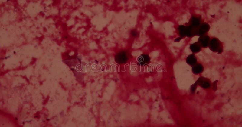 Bacteria Under a Microscope in a Hospital Stock Footage - Video of ...