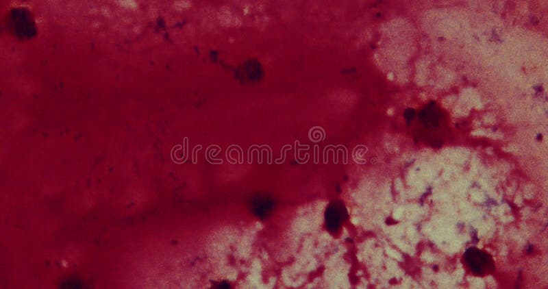 Bacteria Under a Microscope in a Hospital Stock Footage - Video of ...