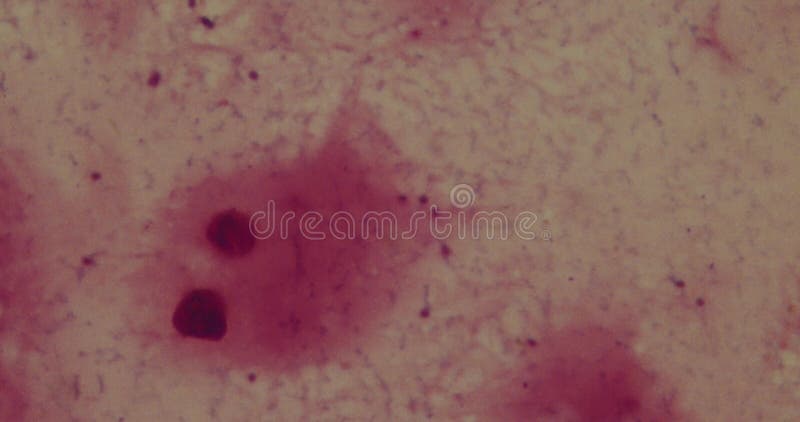 Bacteria Under a Microscope in a Hospital Stock Footage - Video of ...