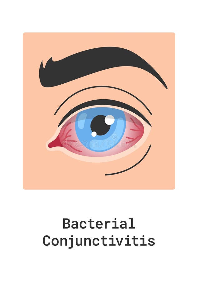 Bacterial Conjunctivitis Eye Disease Stock Vector - Illustration of ...