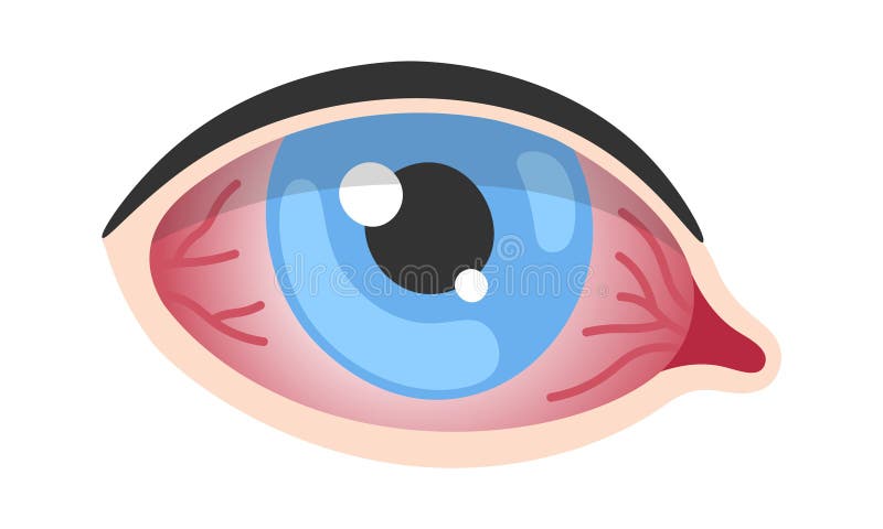 Bacterial Conjunctivitis Eye Disease Stock Vector - Illustration of ...