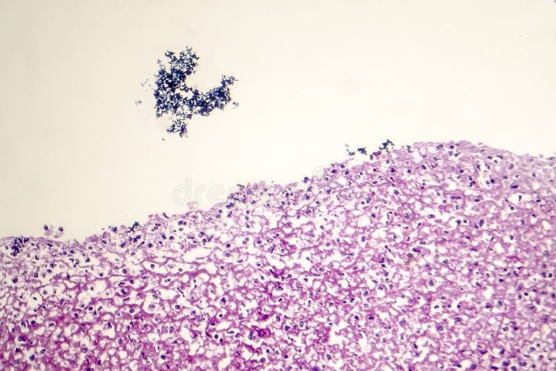 Bacterial Dysentery, Light Micrograph Stock Photo - Image of eosin ...