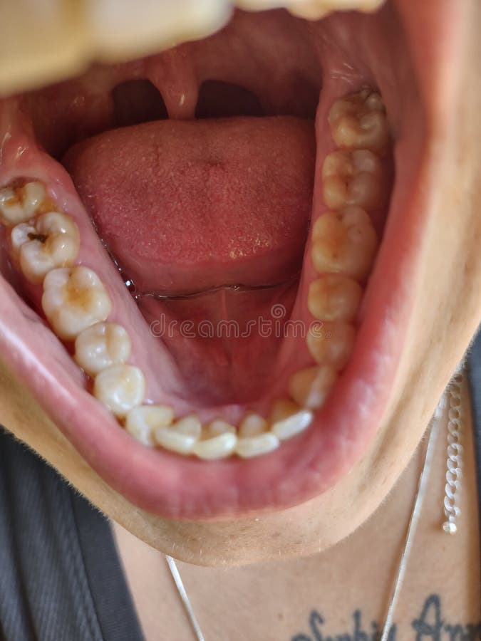 Bad decaying teeth stock image. Image of organ, mouth - 223976693