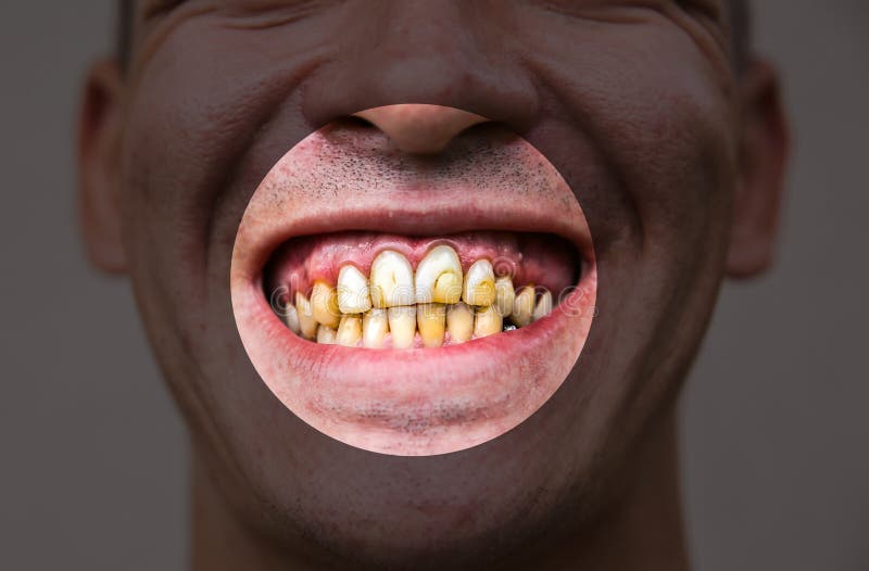 Bad Man Teeth. Low-quality Cavity Fillings Stock Photo - Image of smile ...