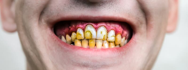 Bad Man Teeth. Low-quality Cavity Fillings Stock Photo - Image of ...