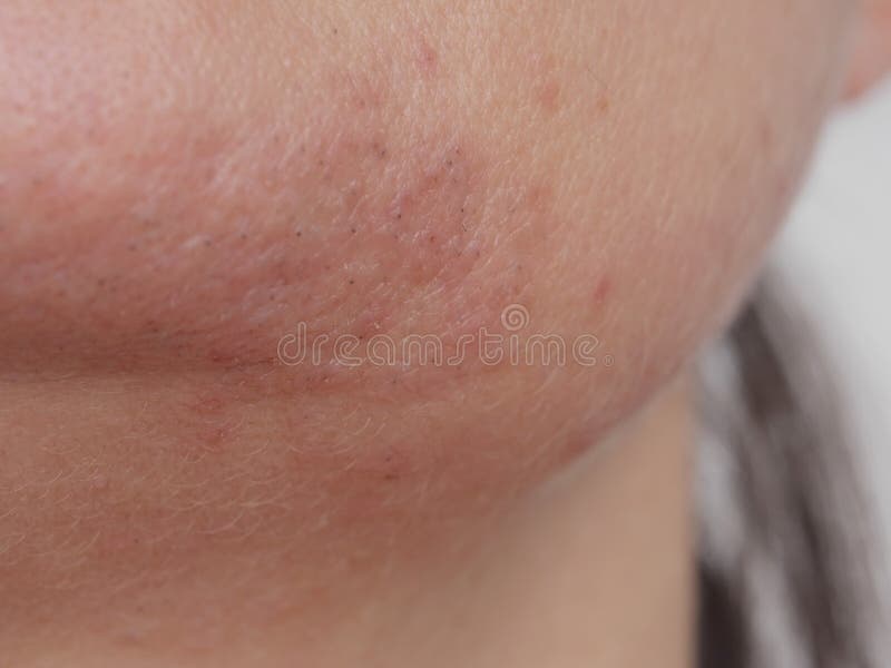 Bad skin close-up stock image. Image of medical, couperose - 76478475