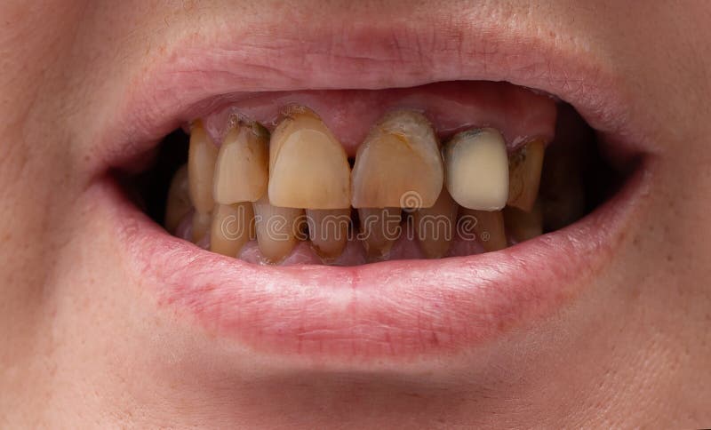 Bad spoiled teeth stock image. Image of dental, patient - 167381081