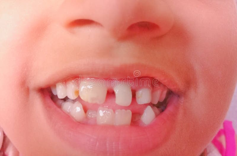 Bad teeth stock image. Image of baby, teeth, small - 130539201