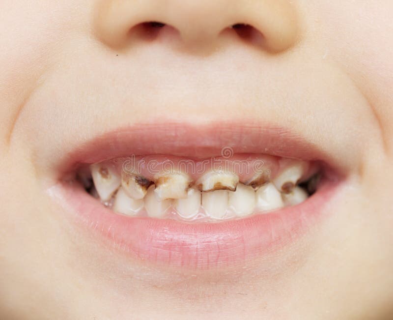 Bad teeth stock image. Image of expressions, head, lips - 54129695