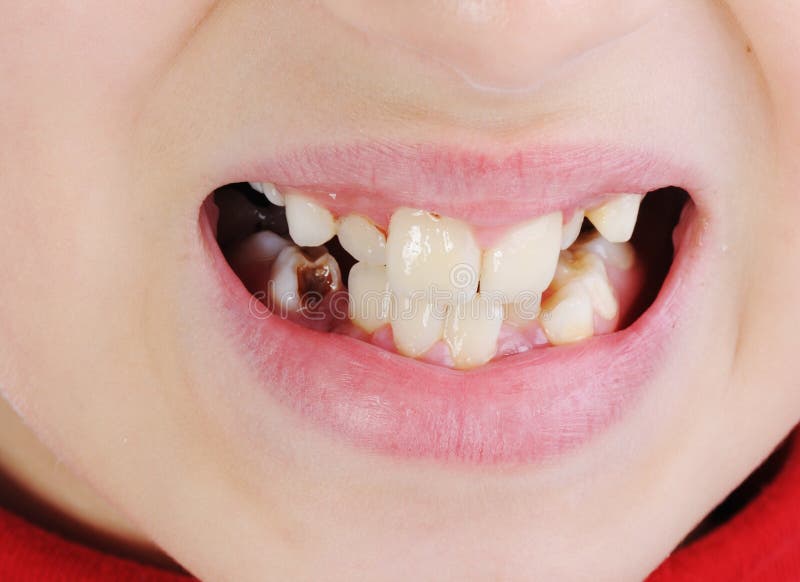Bad teeth, closeup stock image. Image of clinical, clinic - 13048313