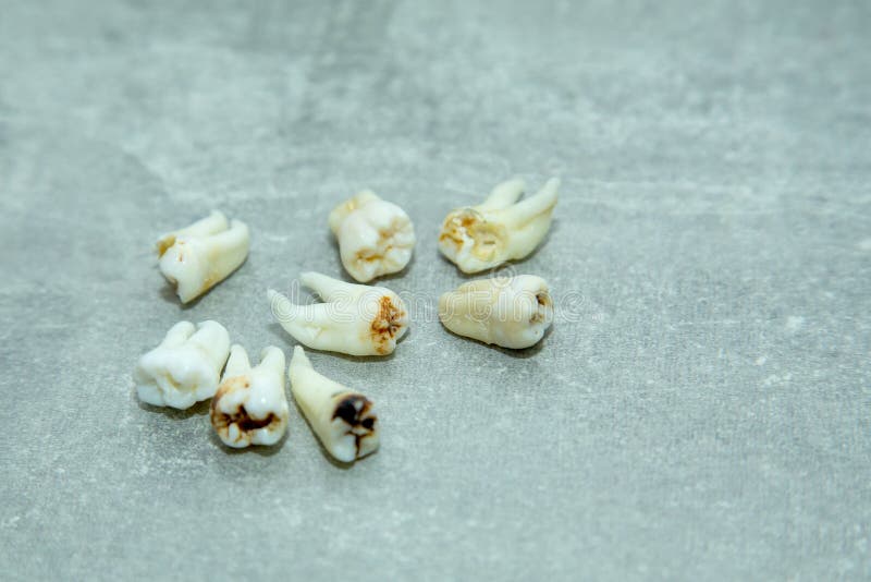 Bad Teeth in the Dental Office Stock Image - Image of checkup, hispanic ...