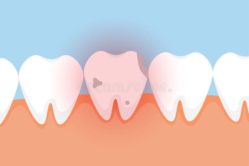 Bad Tooth Hurting with Red Danger Glow Effect Vector. a Dead Tooth ...