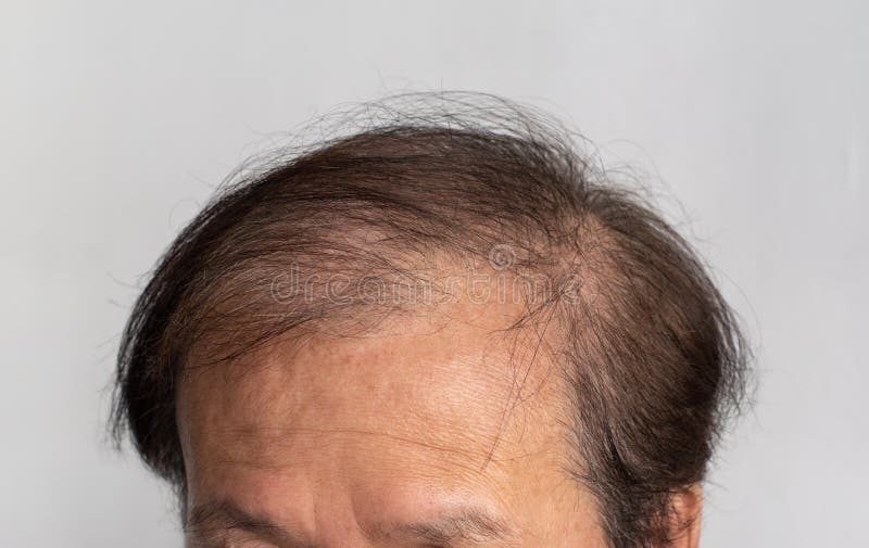 Bald Head of Asian Man. Concept of Male Pattern Hair Loss or Sparse ...