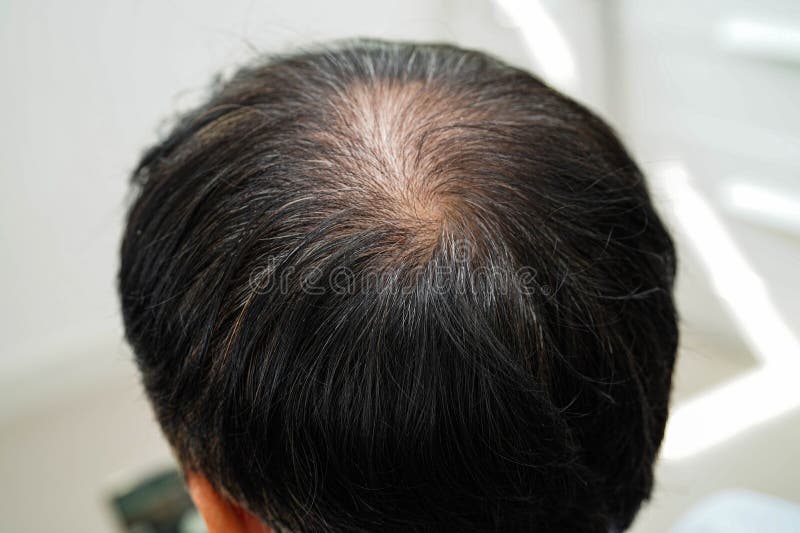 Bald Head in Man, Hair Loss Treatment Health Problem Stock Photo ...