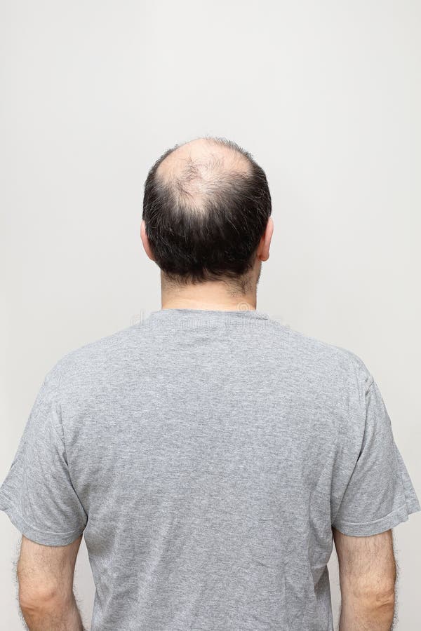 Bald Head stock photo. Image of stress, baldness, loss - 85989020