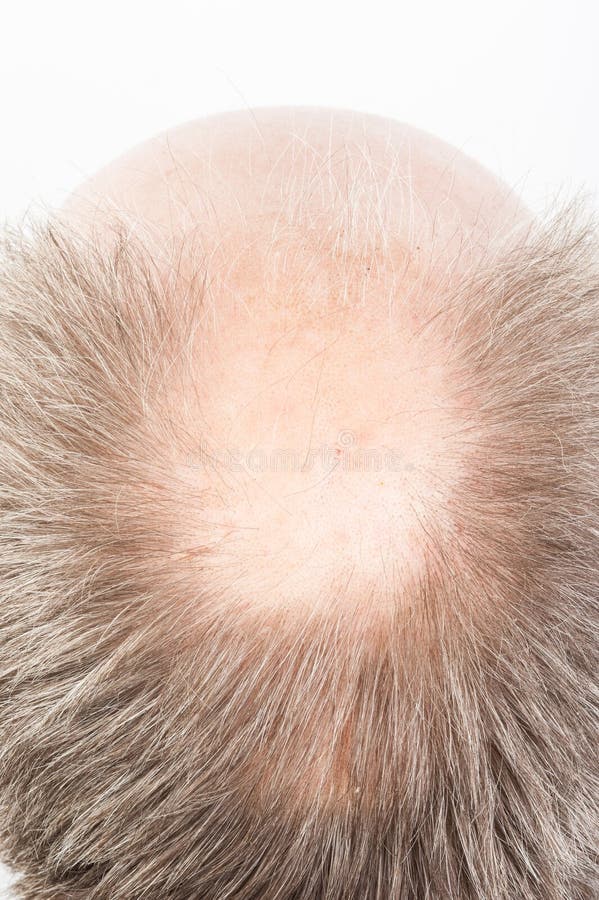 Bald head stock image. Image of baldness, human, loss - 81709183