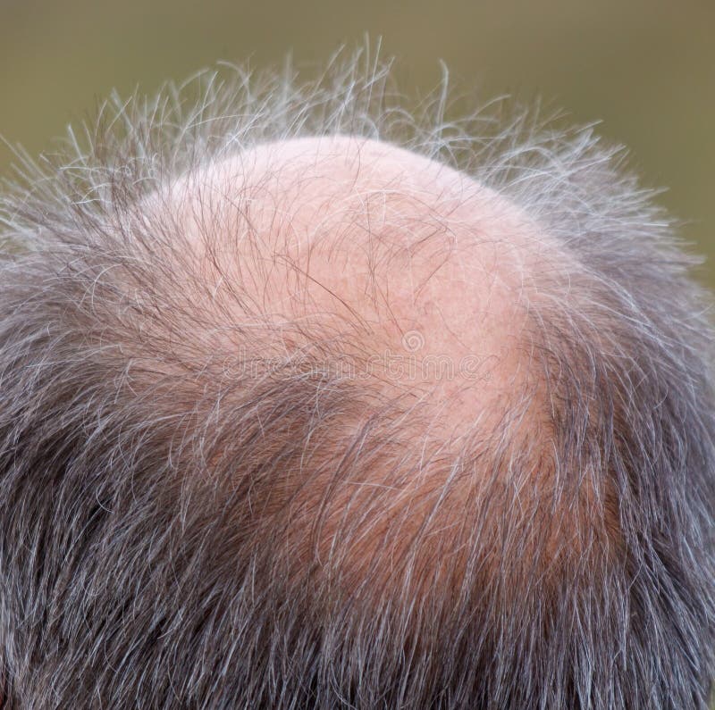 A Bald Man with a Bald Spot on His Head Stock Photo - Image of care ...