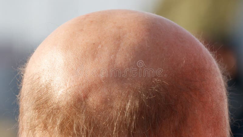 A Bald Man with a Bald Spot on His Head Stock Image - Image of scalp ...