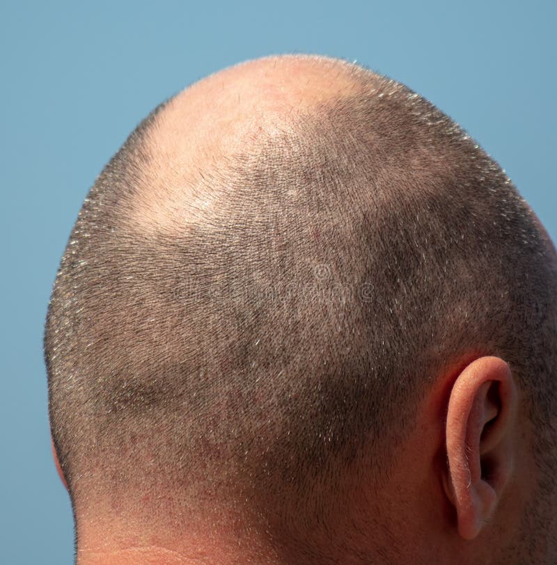Bald Patch on a Man S Head Against a Sky. Stock Photo - Image of neck ...