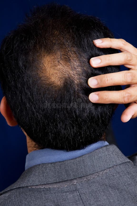 Bald Spot stock photo. Image of dark, suit, spot, hairless - 1558410