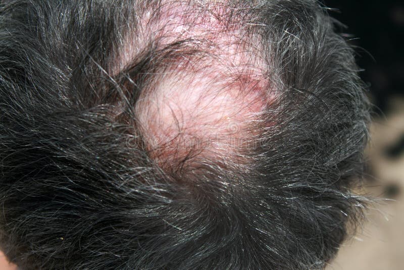 Bald Spot on His Head. Inflamed Red Skin Stock Photo - Image of ...