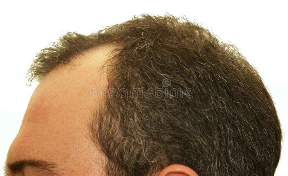 Balding head stock photo. Image of remedy, close, bald - 5300258