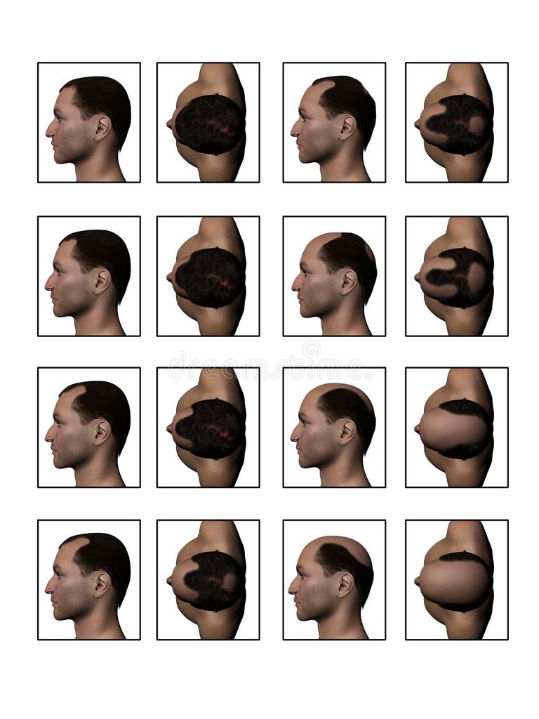 Receding Hairline Stock Illustrations – 958 Receding Hairline Stock ...