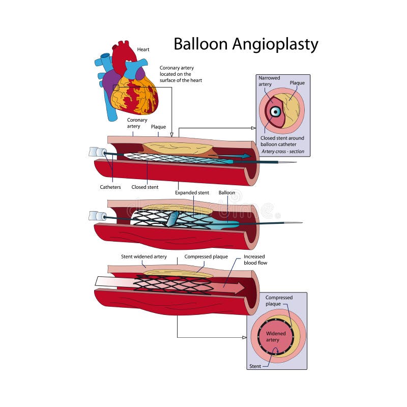 Human Heart Balloon Angioplasty. Stock Vector - Illustration of balloon ...
