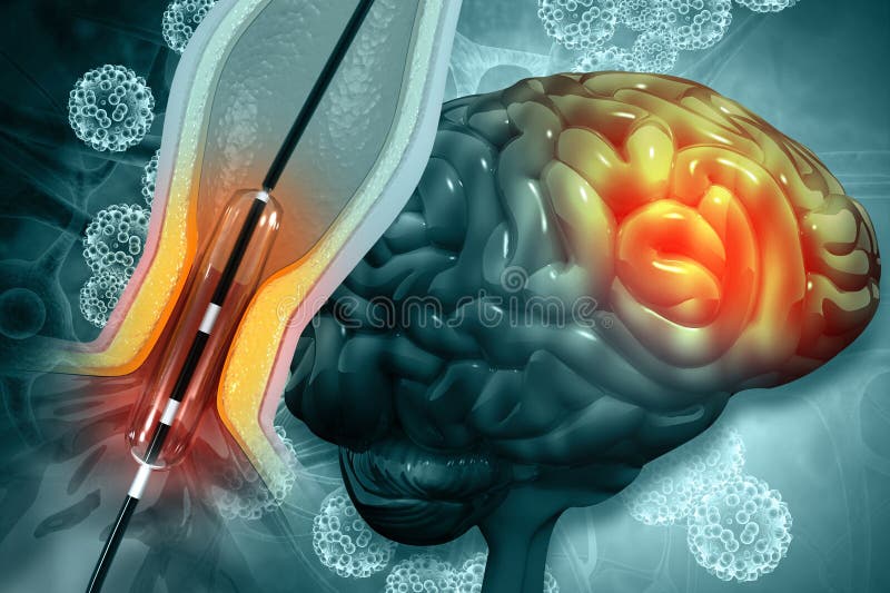 Balloon Angioplasty Procedure with Stent in Vein Stock Illustration ...