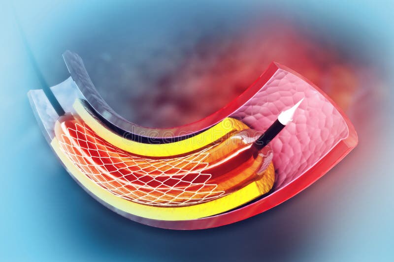 Balloon Expandable Stent. Anatomical Concept Stock Illustration ...