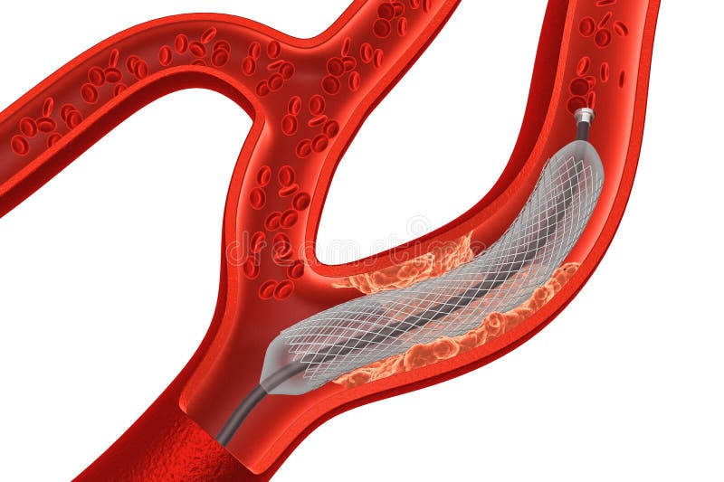 Brain Stent Stock Illustrations – 185 Brain Stent Stock Illustrations ...