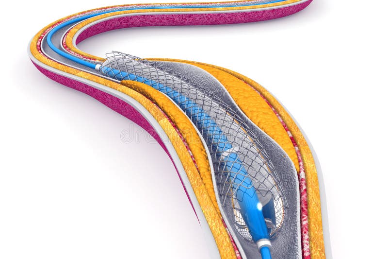 Balloon Expandable Stent stock illustration. Illustration of operating ...