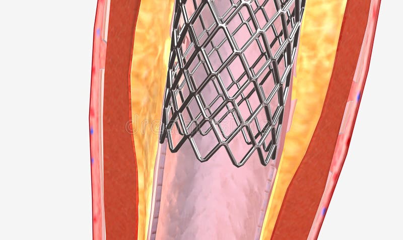 The Balloon Expends, Widening the Wire Mesh Stent and the Artery Stock ...