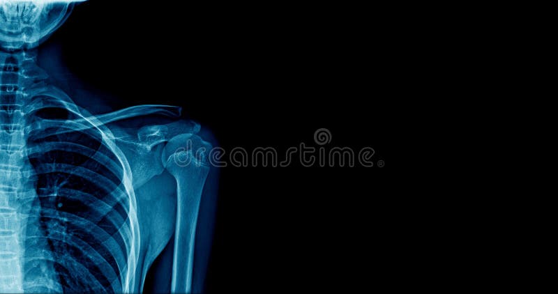 Banner shoulder x-ray stock photo. Image of anatomical - 123022866