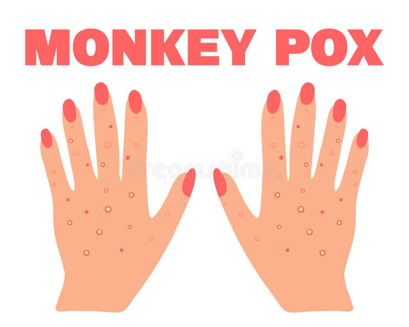 Banner with Smallpox Monkey. Monkey Pox. Hands with a Rash. Smallpox ...