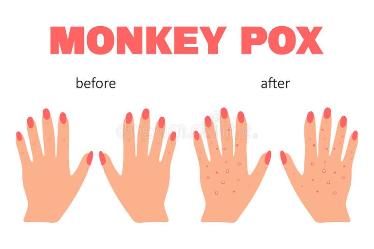 Banner with Smallpox Monkey. Monkey Pox. Hands with a Rash. Smallpox ...