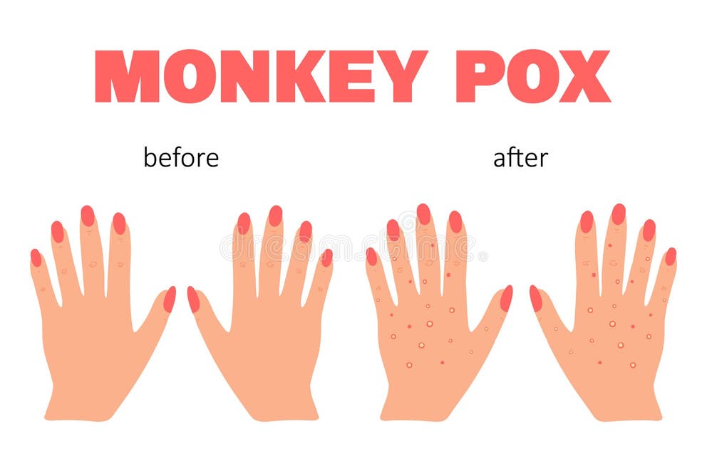 Banner with Smallpox Monkey. Monkey Pox. Hands with a Rash. Smallpox ...