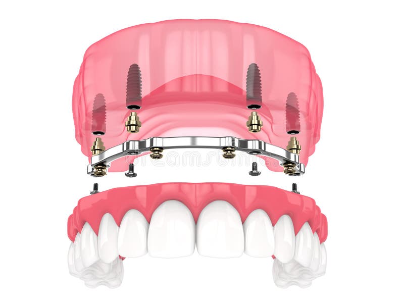 Bar Retained Removable Overdenture Installation Supported by Implants ...