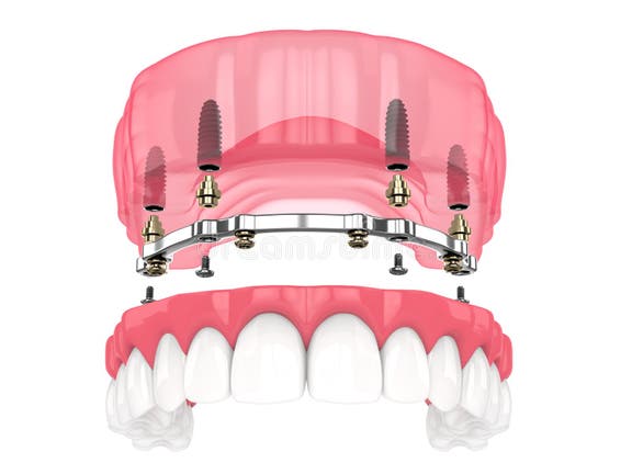 Bar Retained Removable Overdenture Installation Supported by Implants ...