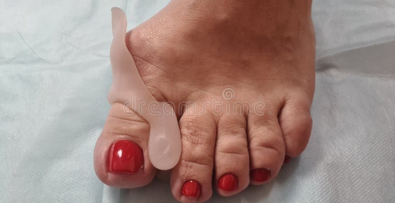 Bare Foot with Bursitis Hallux Valgus Problem Stock Image - Image of ...