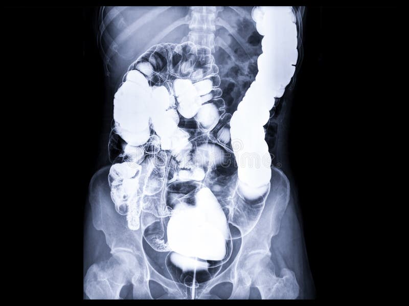 Barium Enema or BE is Image of Large Bowel after Injection of Barium ...