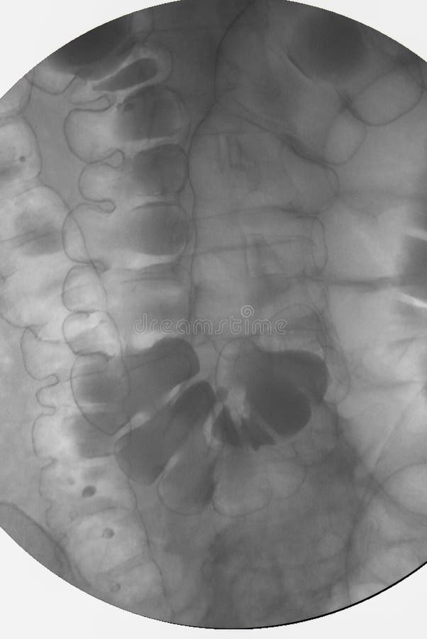Barium Enema, Double Contrast Study, Colorectal X-ray Stock Photo ...