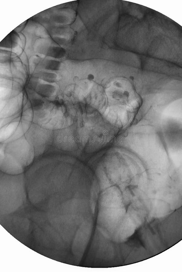 Barium Enema Image or X-ray Image of Large Intestine. Colorectal X-ray ...