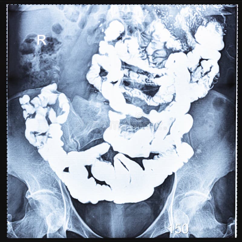Barium Study of Small Bowel in Two and Half Hours Stock Photo - Image ...