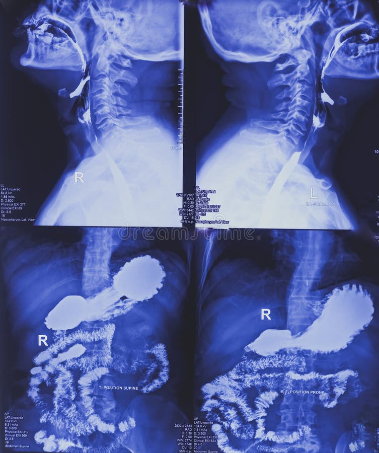 Barium Swallow of Oesophagus Examination X-ray. Showing Upper Digestive ...