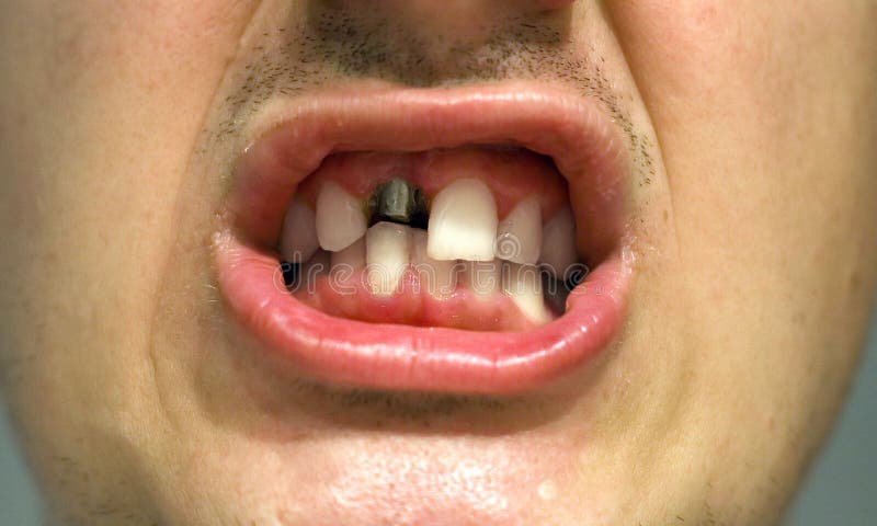 Tooth stub for crown stock photo. Image of filling, interdental - 13823948