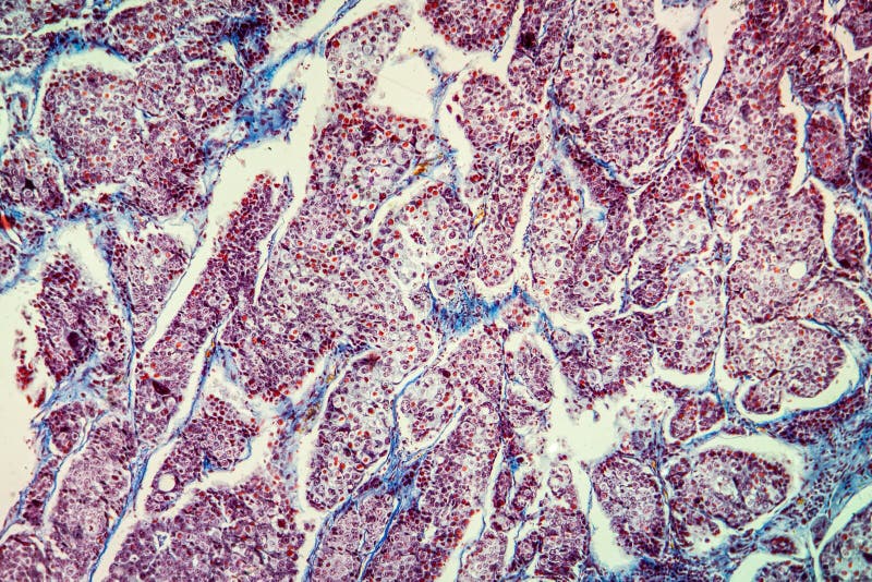 Basal Cell Cancer Diseased Tissue Stock Photo - Image of pathology ...