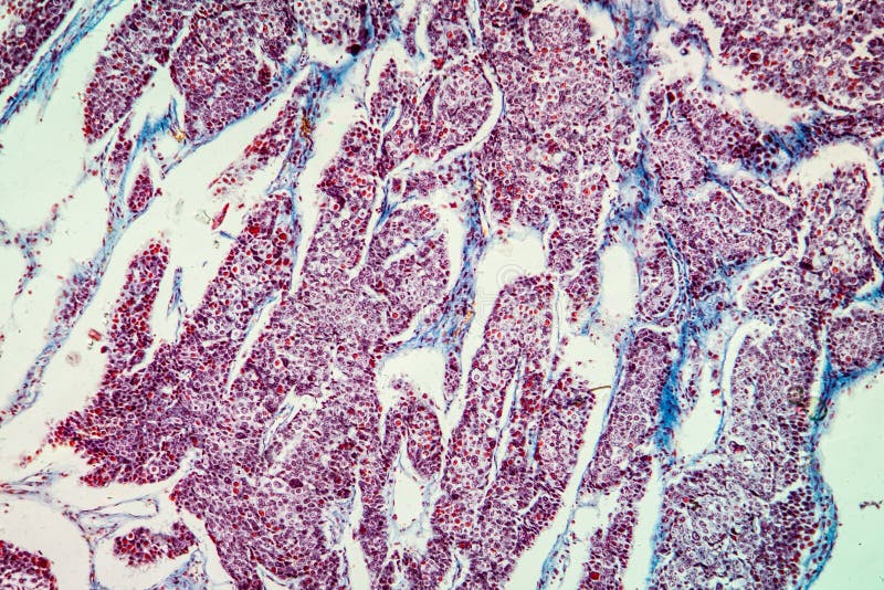 Basal Cell Carcinoma, Light Micrograph Stock Image - Image of imaging ...