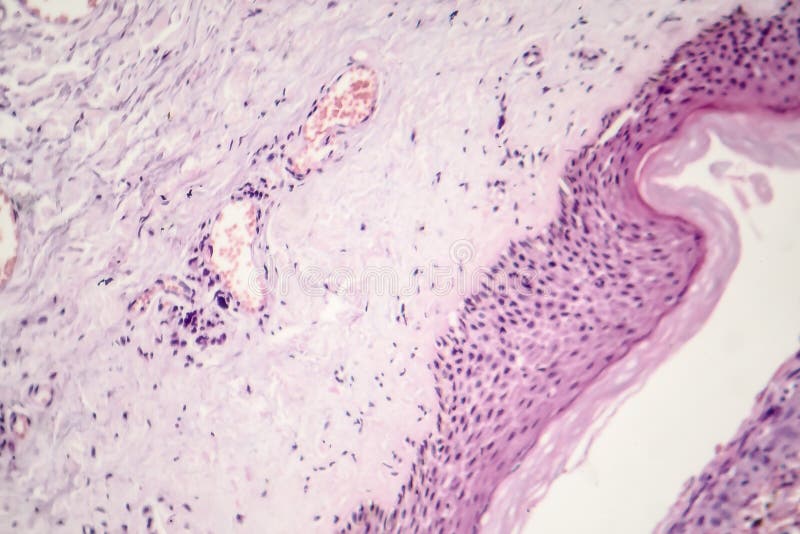 Basal cell carcinoma stock image. Image of microscope - 128777959