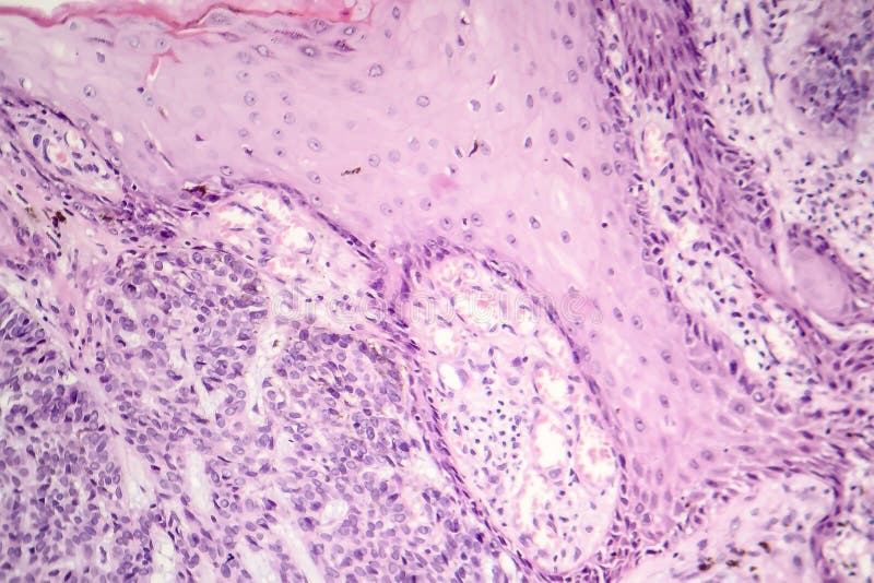 Basal cell carcinoma stock photo. Image of stain, hematoxylin - 128778034